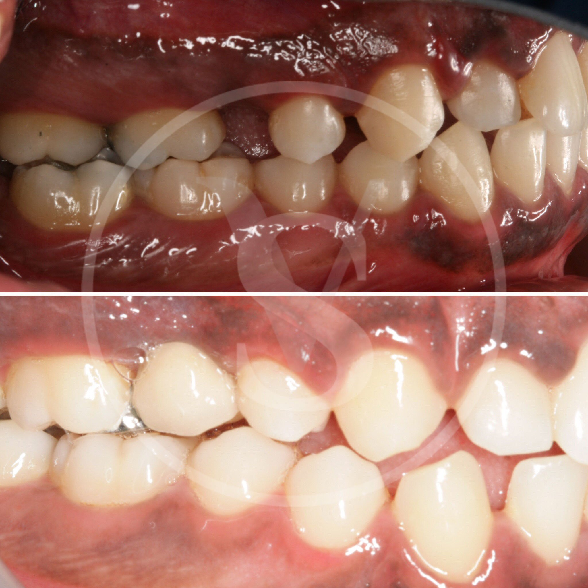 Dental Crown Harrow - Dental Bridge Wembley