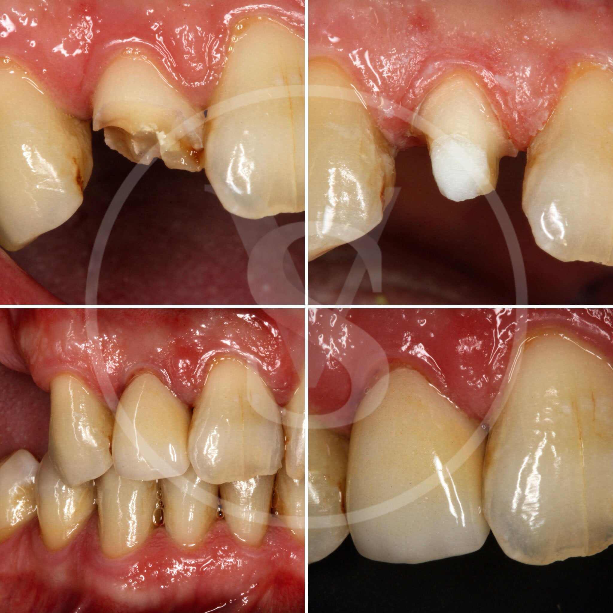 Dental Crown Harrow - Dental Bridge Wembley
